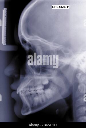 X-ray teeth mandible human skull. Panoramic negative photo facial image ...