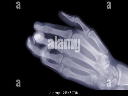 Xray of bent of human Hand fingers side view. X-ray of male hand and ...