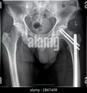 X-ray image of multiple fractures after a traffic accident Stock Photo ...