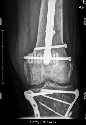 X-ray image of multiple fractures after a traffic accident Stock Photo ...