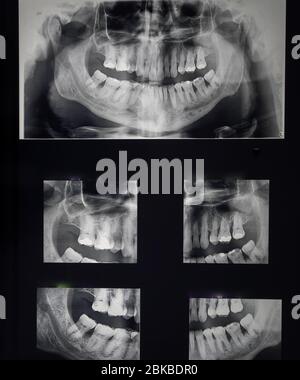 odontostomalogical radiographs, digital orthopantomography for dental ...