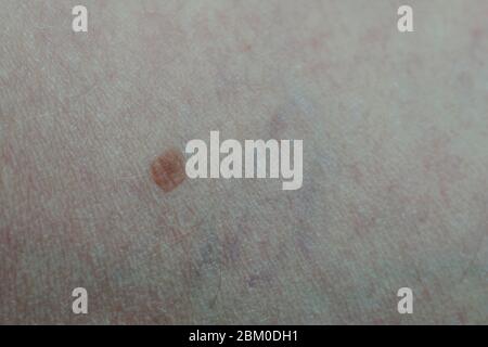 Squamous cell carcinoma on a leg. This pink, raised lesion is a form of ...