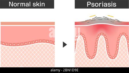 Cross section of psoriasis and normal skin / flat vector illustration ...