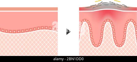 Cross section of psoriasis and normal skin / flat vector illustration ...