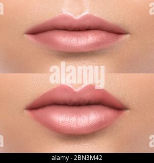 Comparison of female lips after augmentation Stock Photo - Alamy