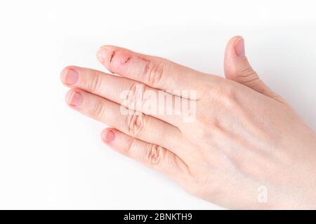 a cut index finger with a extensor tendon injury, mallet finger, tip of ...