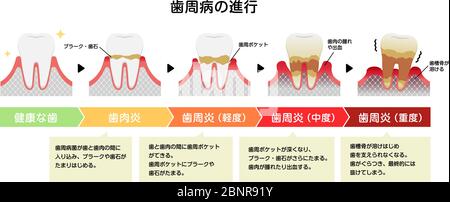 The stages of periodontitis disease vector illustration Stock Vector ...