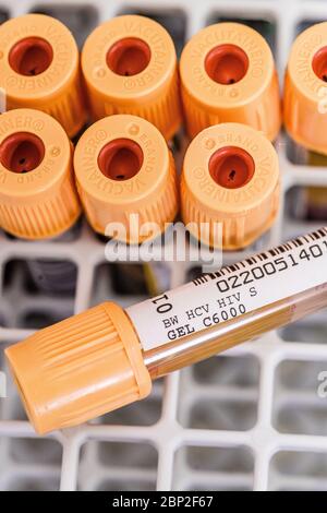 Syphilis, HIV, and Hepatitis B virus blood sample collection tubes held ...