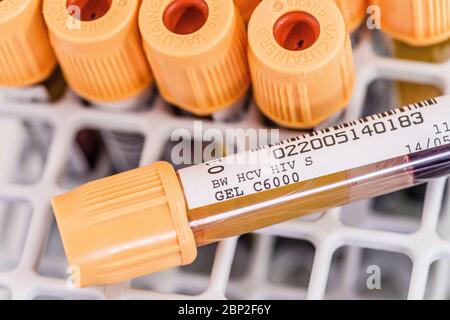 Syphilis, HIV, and Hepatitis B virus blood sample collection tubes held ...