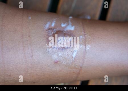 The scald on the foot skin caused by the boiling cooking oil Stock ...