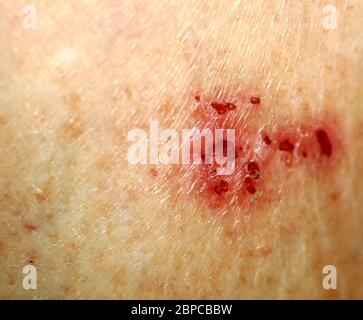 Psoriasis dry red and white irritation on the skin closeup Stock Photo ...