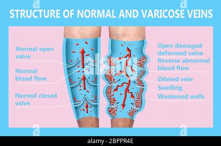The structure of normal and varicose veins Stock Photo - Alamy