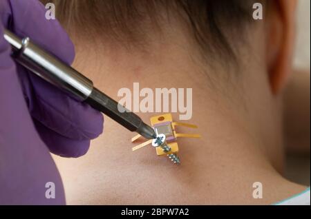 implantation of chip under the human skin. microchip is connected to ...