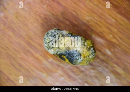 Large gallstone, Gall bladder stone. The result of gallstones. A ...