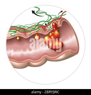 Illustration showing large digestive with intestinal polyp, malignancy ...