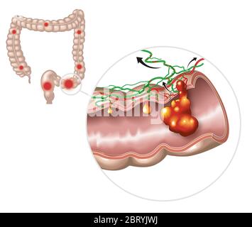 Illustration showing large digestive with intestinal polyp, malignancy ...
