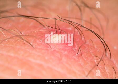 Close up photo of nodular cystic acne skin Stock Photo - Alamy