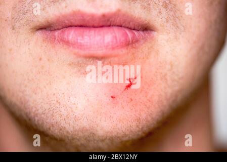 Scar on chin. Close-up of an infected scar on a patient's chin ...