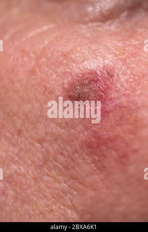 Red crusty lesions of actinic keratosis or sunspots on sun-damaged skin ...