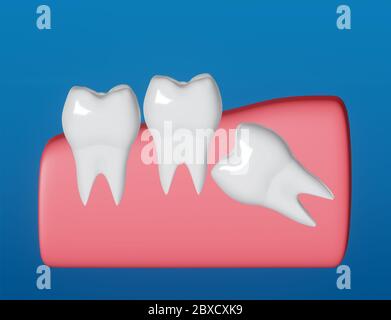 Wisdom tooth grows wrong, wisdom tooth problem, horizontal position of ...