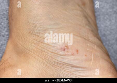 HPV Close-up shot of a plantar wart on the bottom of the big toe caused ...