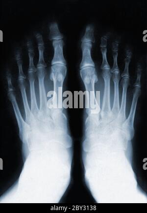 X ray image of Foot fingers Stock Photo - Alamy