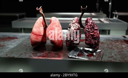 Smoker's lungs, illustration Stock Photo - Alamy