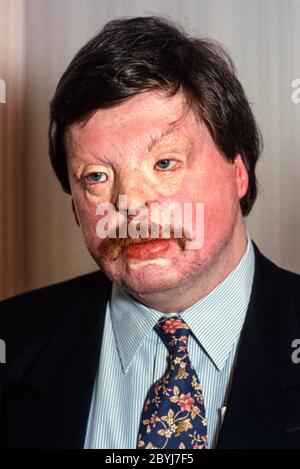 Simon Weston charity worker veteran of the British Army who suffered ...