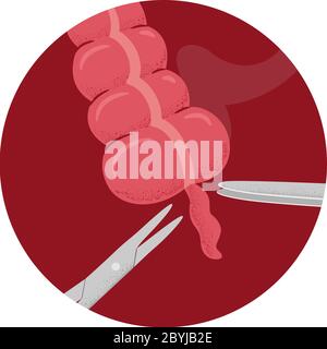 Medical illustration of an appendix with appendicitis Stock Photo - Alamy