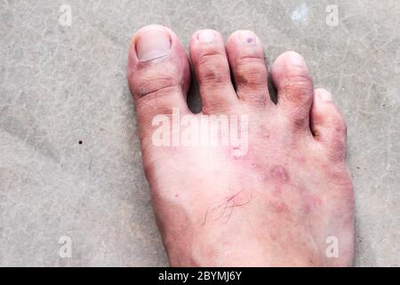 closeup skin athlete’s foot psoriasis fungus, hong kong foot, foot ...