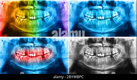 Panoramic radiograph is a scanning dental X-ray of the upper jaw ...
