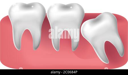 3D Realistic Tooth Extraction Vector Illustration. Teeth Treatment and ...