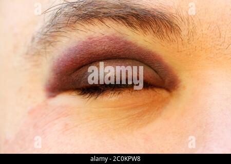 Man with bruise eye hematoma. Wounded victim with black eye Stock Photo ...