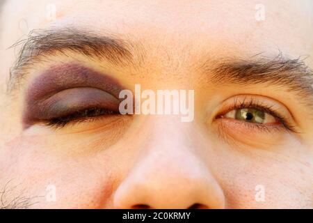 Violence fight eye hematoma shiner close-up. Portrait of a man with ...