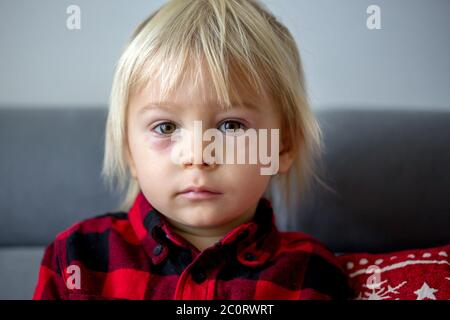 Blonde toddler boy with red burned spot under the eye, feeling pain ...