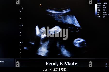 Colourful ultrasound monitor image. Fetal Heart, B mode Stock Photo - Alamy