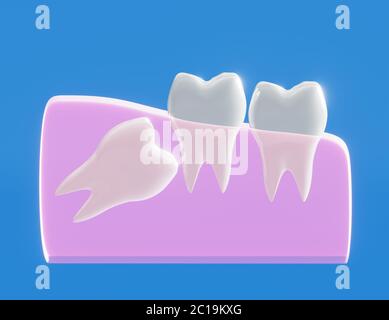 Wisdom tooth grows wrong, wisdom tooth problem, horizontal position of ...