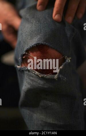 Scratched knee under ripped jeans after accident, open wound with blood ...
