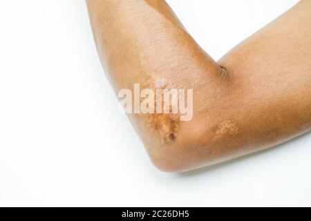 Closeup keloid scar on elbow of Asian man skin after motorcycle ...