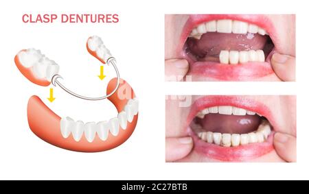Dental rehabilitation with lower flexible nylon denture, before and ...