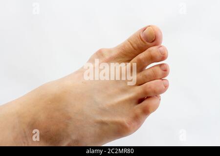 gout on the bones of the foot on white background Stock Photo - Alamy