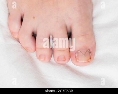 Orthonyx Bracket, toenail clamp is mounted on an ingrown toenail, close ...