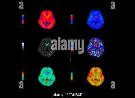 Brain Perfusion or CT scan of Blood flow in the brain 3d rendering ...