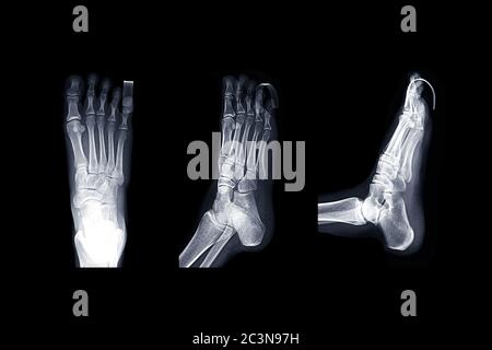 Comparison of X-ray Right foot image AP , oblique and lateral view with ...