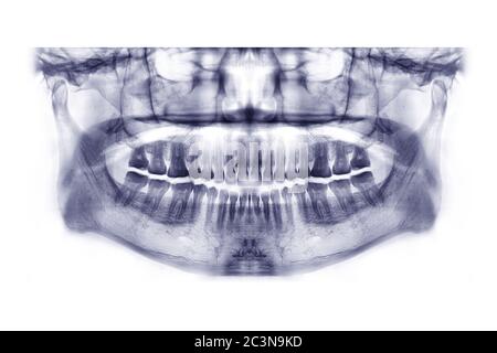 Diagnosis of diseases scan of the teeth. an orthopantomogram isolated ...