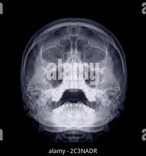 X-ray image of Human Skull Water's view for diagnosis skull fracture ...