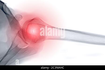 X-ray Shoulder joint shoulder transaxillary view for diagnosis fracture ...