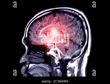 Basilar artery aneurysm, MRI scan Stock Photo - Alamy
