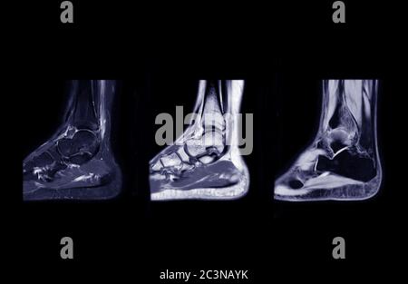 leg break fracture bone break break rupture leg X-ray X-ray picture ...