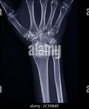 X-ray image of Right wrist joint Ap and Lateral view for diagnosis ...